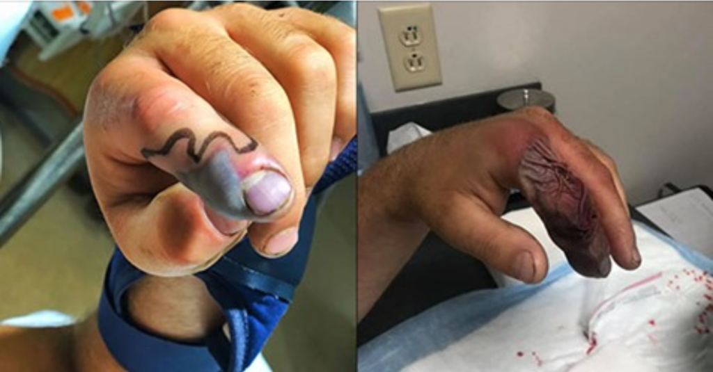 After Effects of a Timber Rattler Bite — The Hunting page